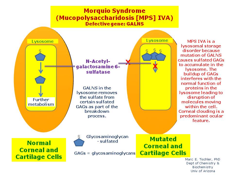 Morquio Syndrome Mps Iva Hereditary Ocular Diseases